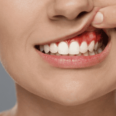 Gengive infiammate: sintomi, cause e trattamenti efficaci